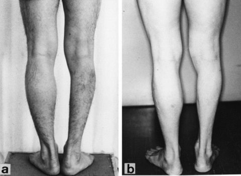 Orthopaedic Treatment for Benign Calf Amyotrophy